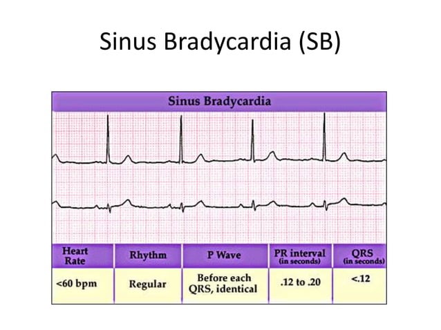 EKG dasar, aritmia SVT, VT, AV block.ppt