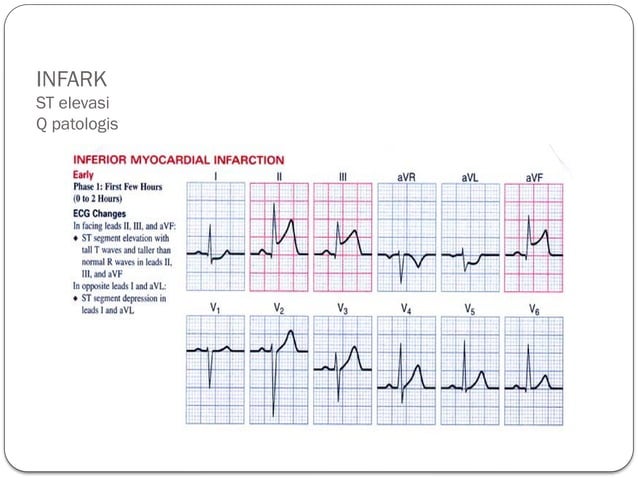 EKG DASAR PEMERIKSAAN PENUNJANG JANTUNG.pptx