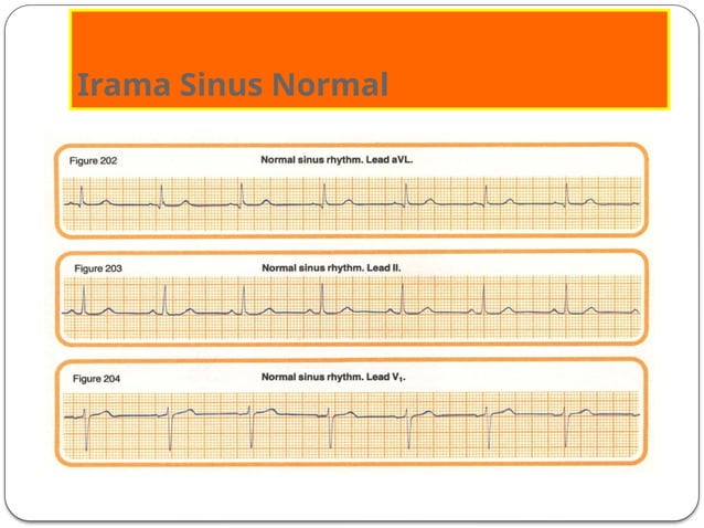 EKG DASAR PEMERIKSAAN PENUNJANG JANTUNG.pptx
