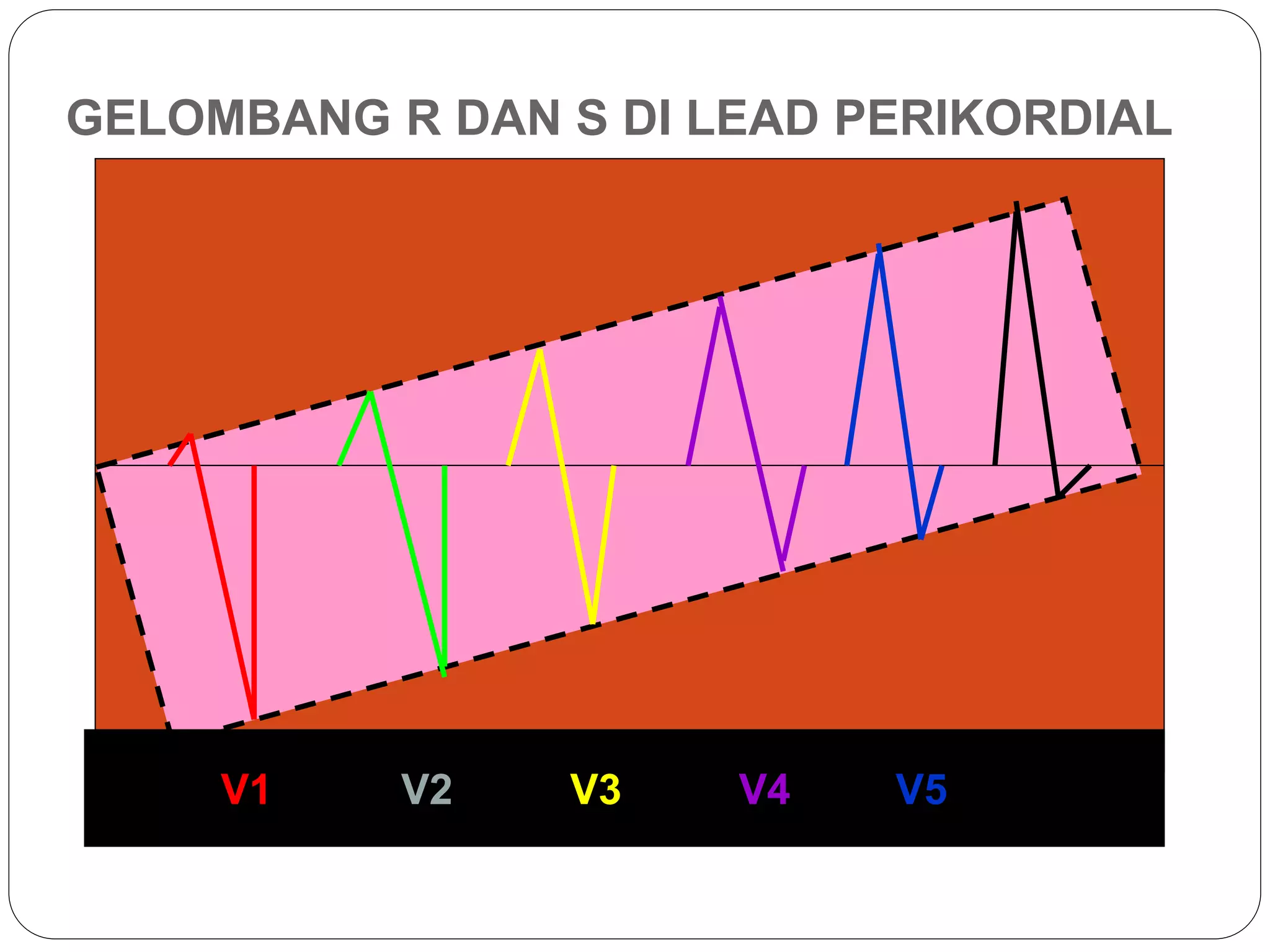 EKG Dasar dan Cara Interpretasi.pptx