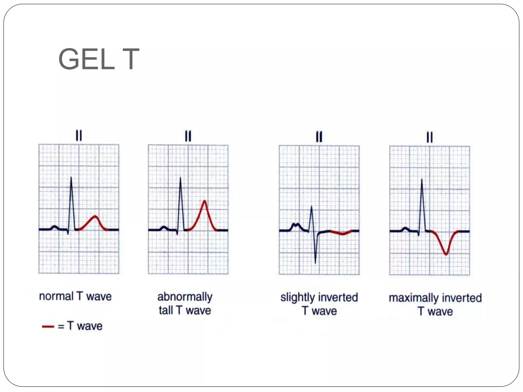 EKG Dasar dan Cara Interpretasi.pptx