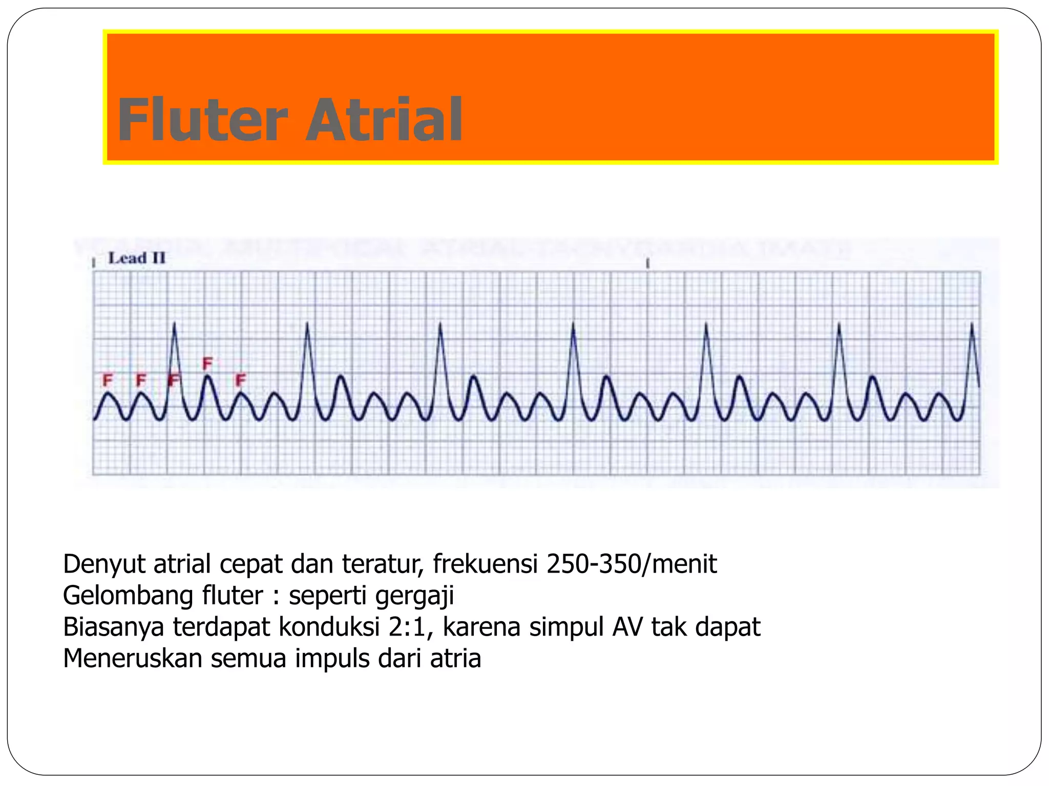 EKG Dasar dan Cara Interpretasi.pptx