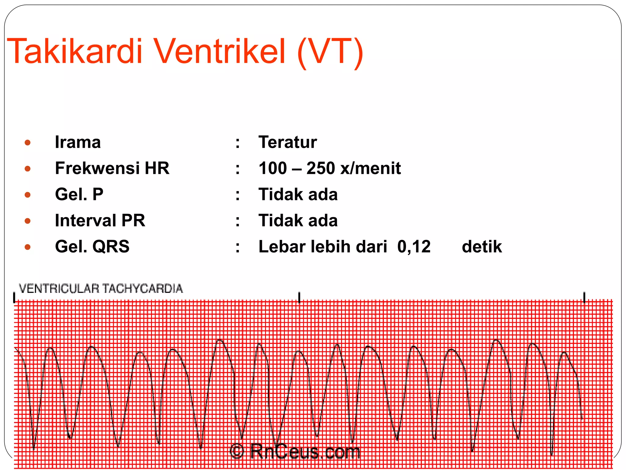 EKG Dasar dan Cara Interpretasi.pptx