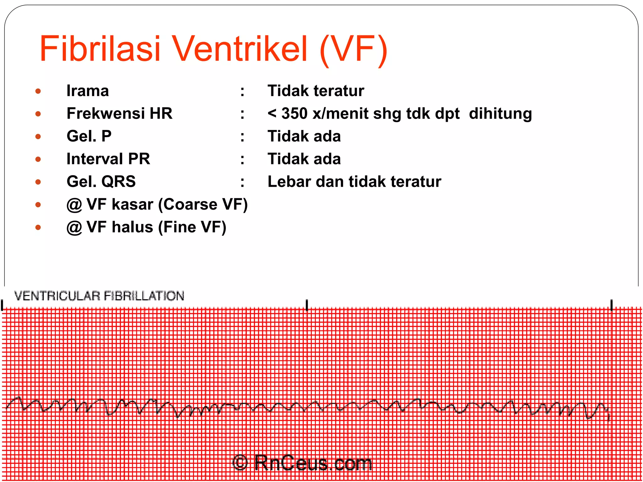 EKG Dasar dan Cara Interpretasi.pptx