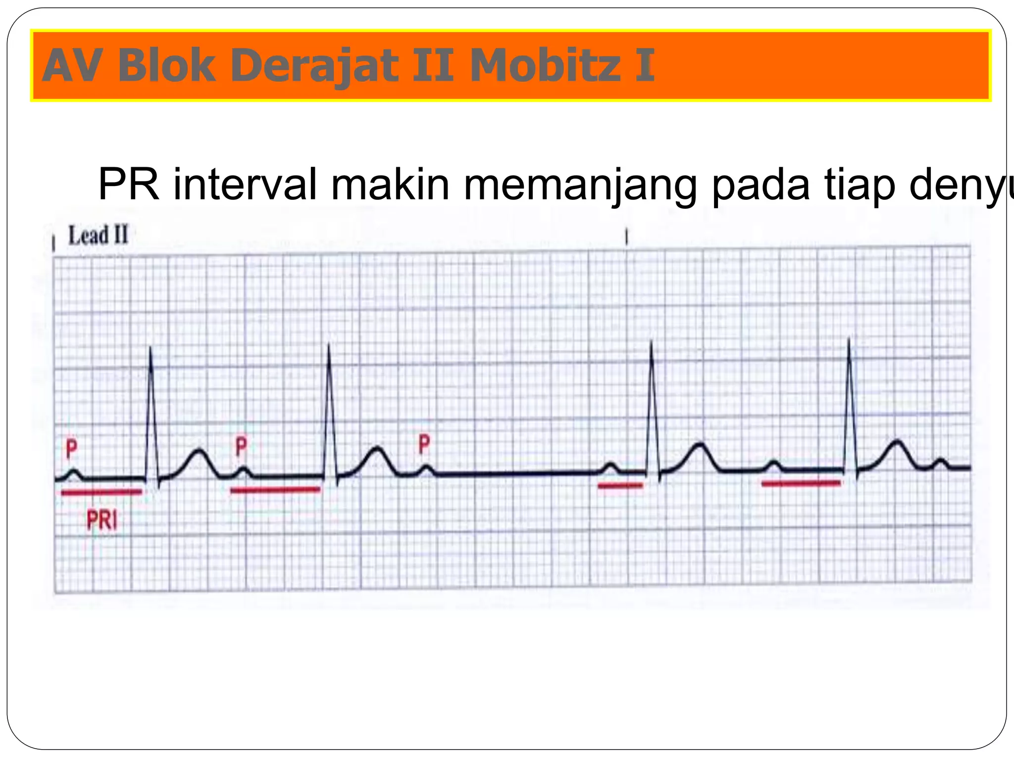 EKG Dasar dan Cara Interpretasi.pptx
