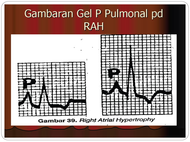 EKG Dasar dan Cara Interpretasi.pptx
