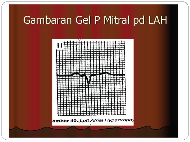 EKG Dasar dan Cara Interpretasi.pptx