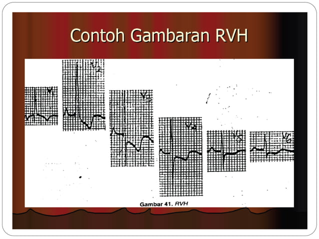 EKG Dasar dan Cara Interpretasi.pptx