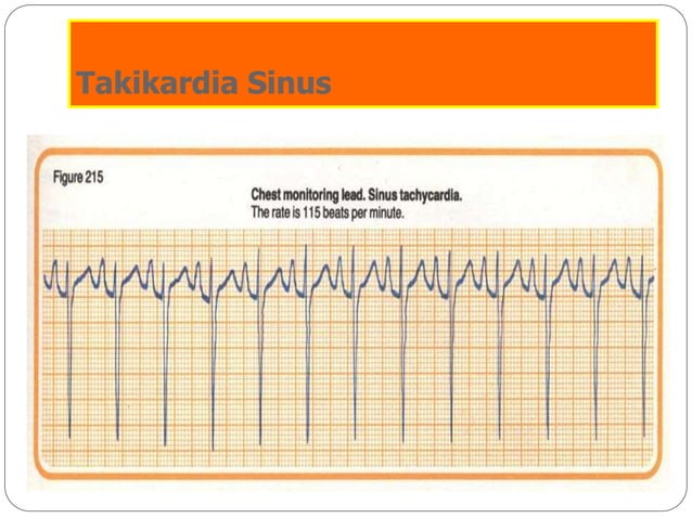 EKG Dasar dan Cara Interpretasi.pptx