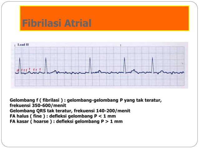 EKG Dasar dan Cara Interpretasi.pptx