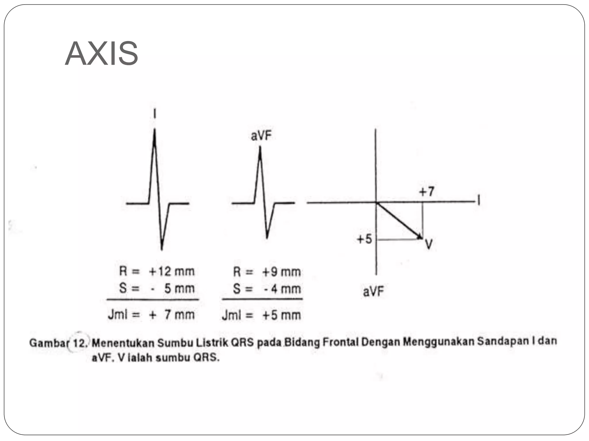EKG_Dasar_dan_Cara_Interpretasi.pptx