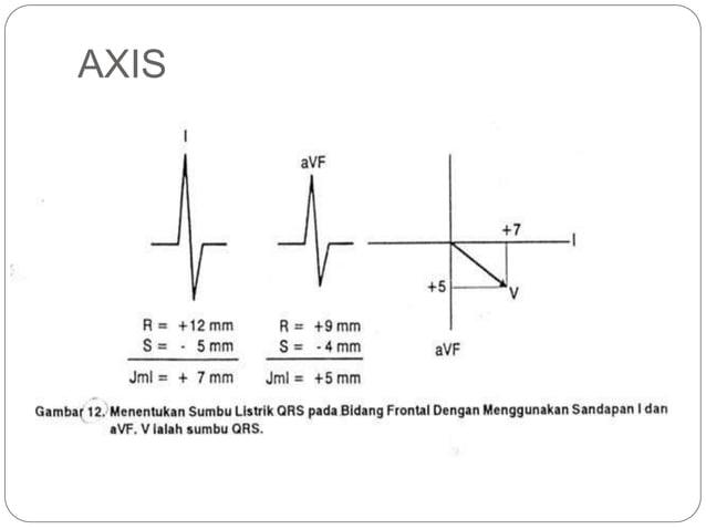 EKG Dasar dan cara interpretasikan dengan cara cepat dimengerti | PPTX