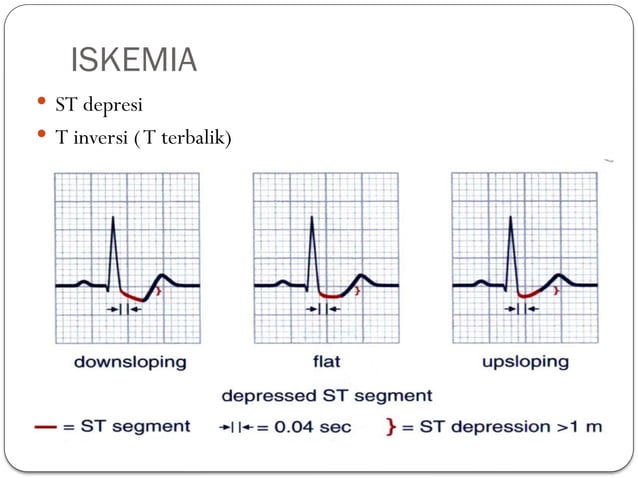 Konsep EKG_Dasar_dan_Cara_Interpretasi.pptx