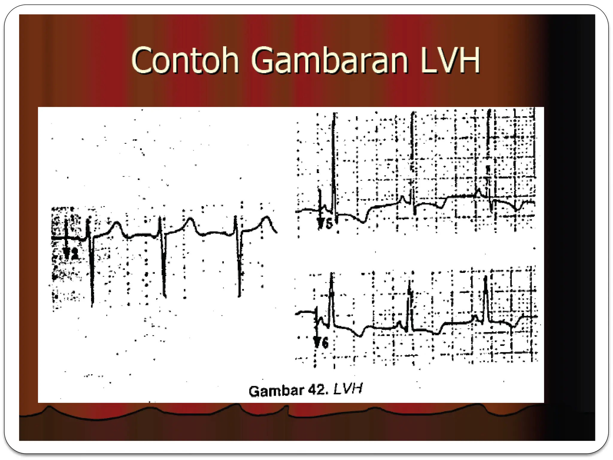 interpretasi EKG_Dasar_dan_Cara_Interpretasi.pptx