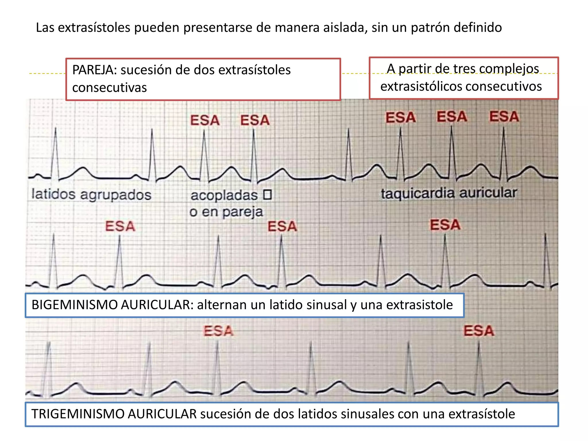 EKG DE ARRITMIAS SUPRAVENTRICULARES.pdf