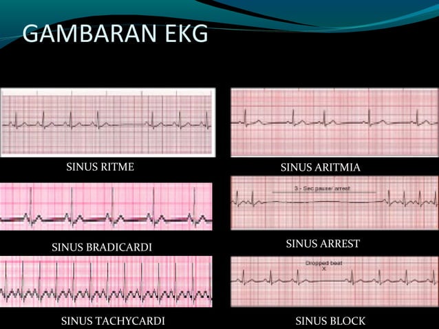EKG, Drug dan Defibrilator | PPT