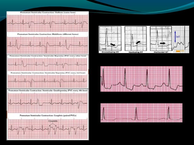 EKG, Drug dan Defibrilator | PPT