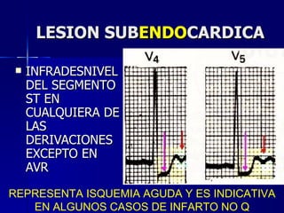 Ekg en la cardiop isquemica | PPT