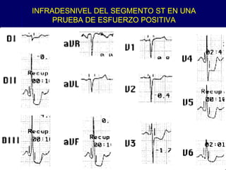 Ekg en la cardiop isquemica | PPT