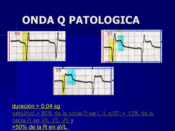 Ekg en la cardiop isquemica
