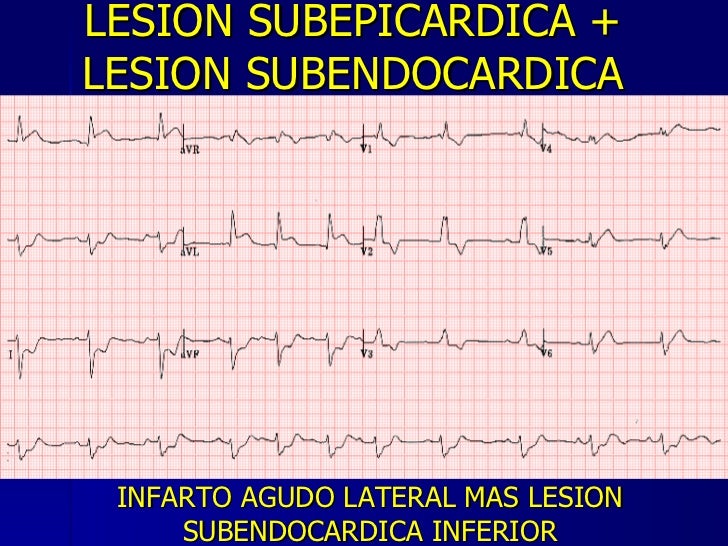 Ekg en la cardiop isquemica