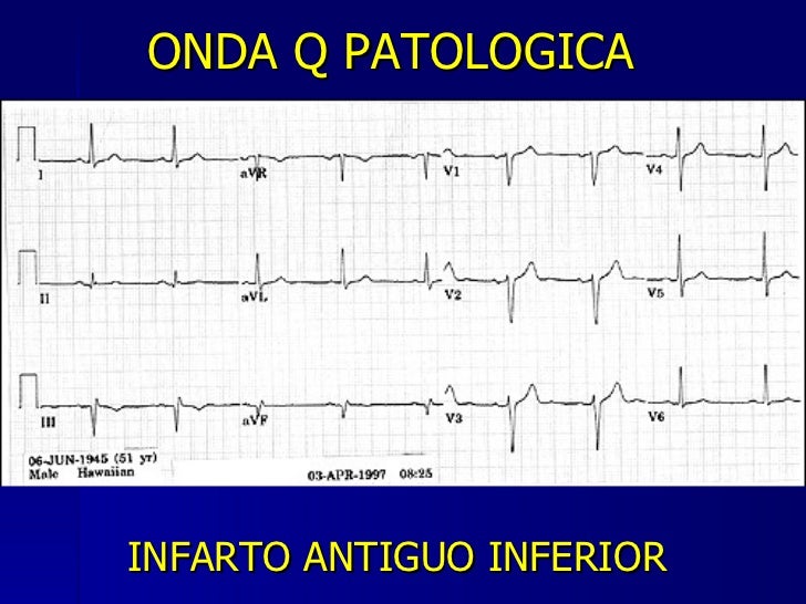 Ekg en la cardiop isquemica