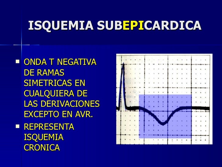 Ekg en la cardiop isquemica