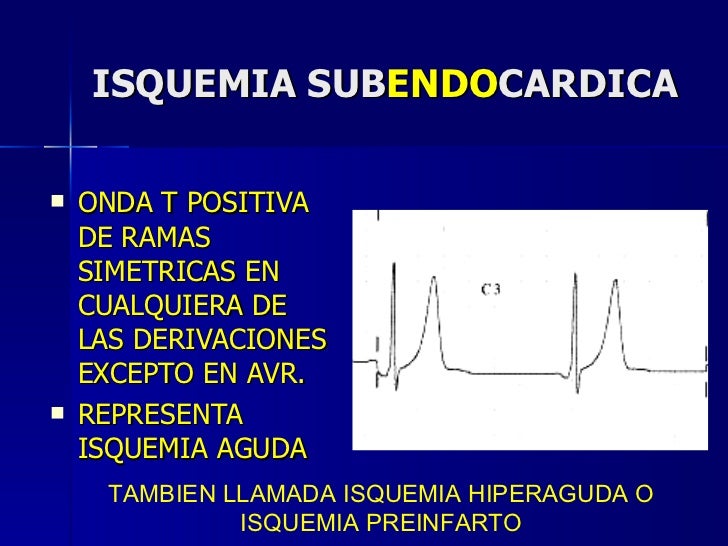Ekg en la cardiop isquemica