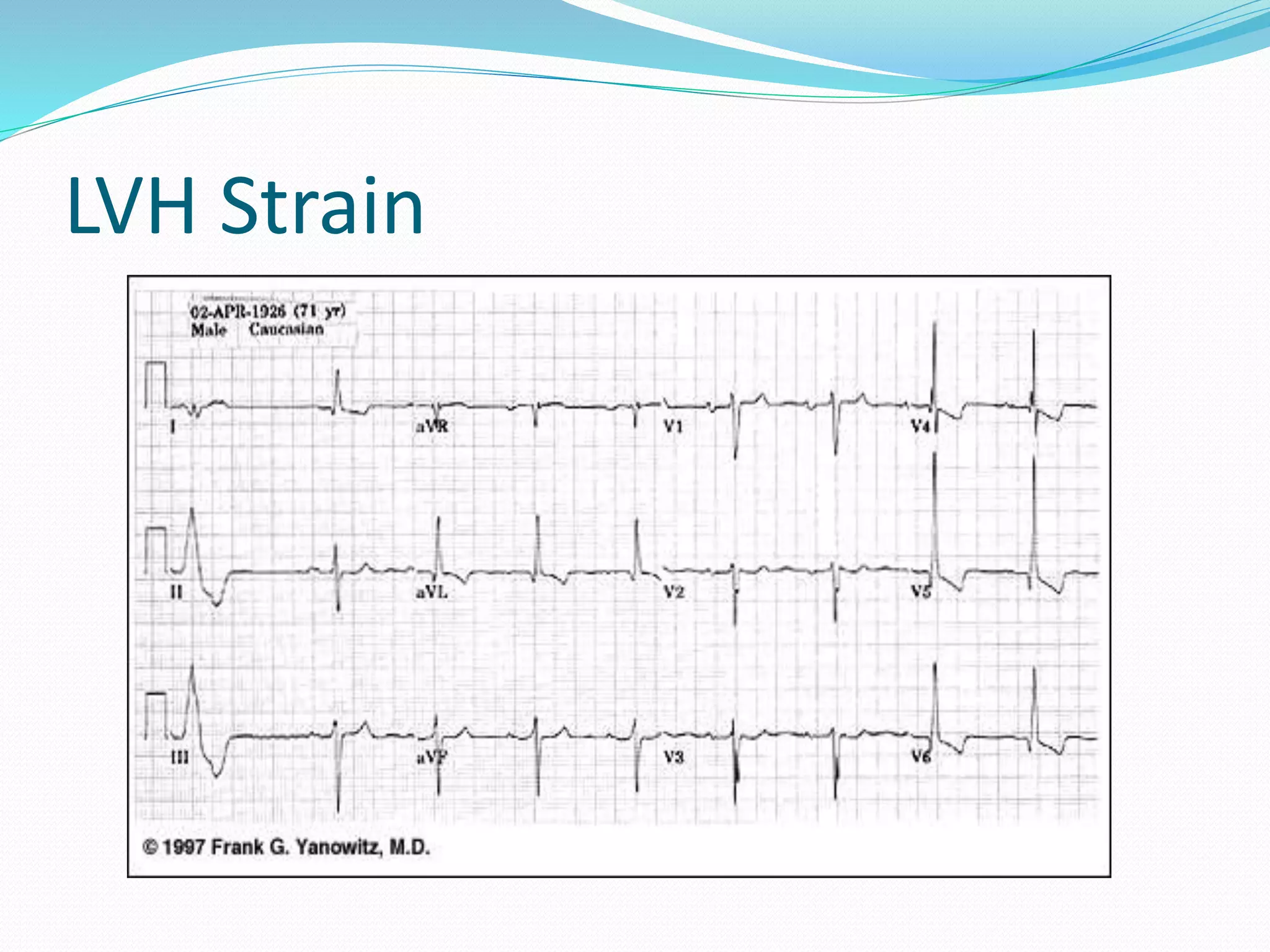 EKG, Hipertrofi Jantung | PPTX