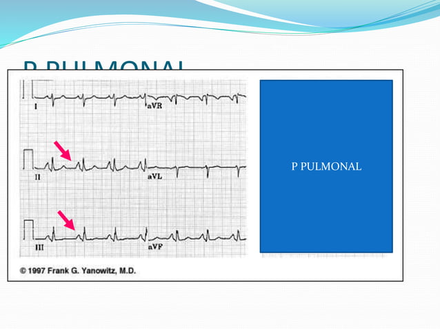 EKG, Hipertrofi Jantung | PPTX