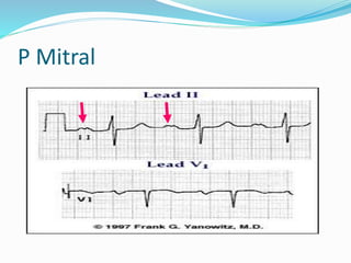 EKG, Hipertrofi Jantung | PPTX