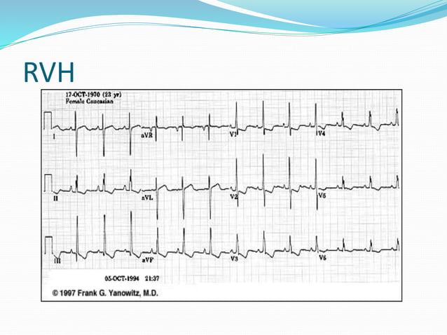 EKG, Hipertrofi Jantung | PPTX