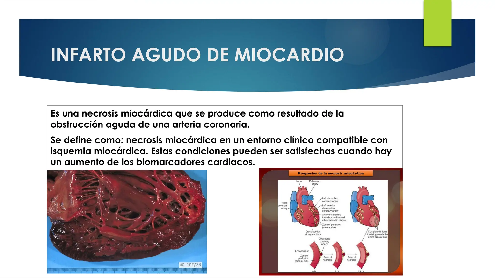 EKG – INFARTO AGUDO DE MIOCARDIO presentacion.pptx