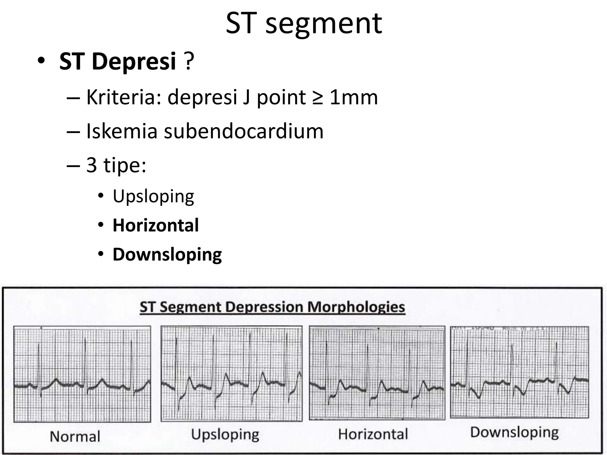 Elektrokardiogram PRO PESERTA made easy and simple | PPTX