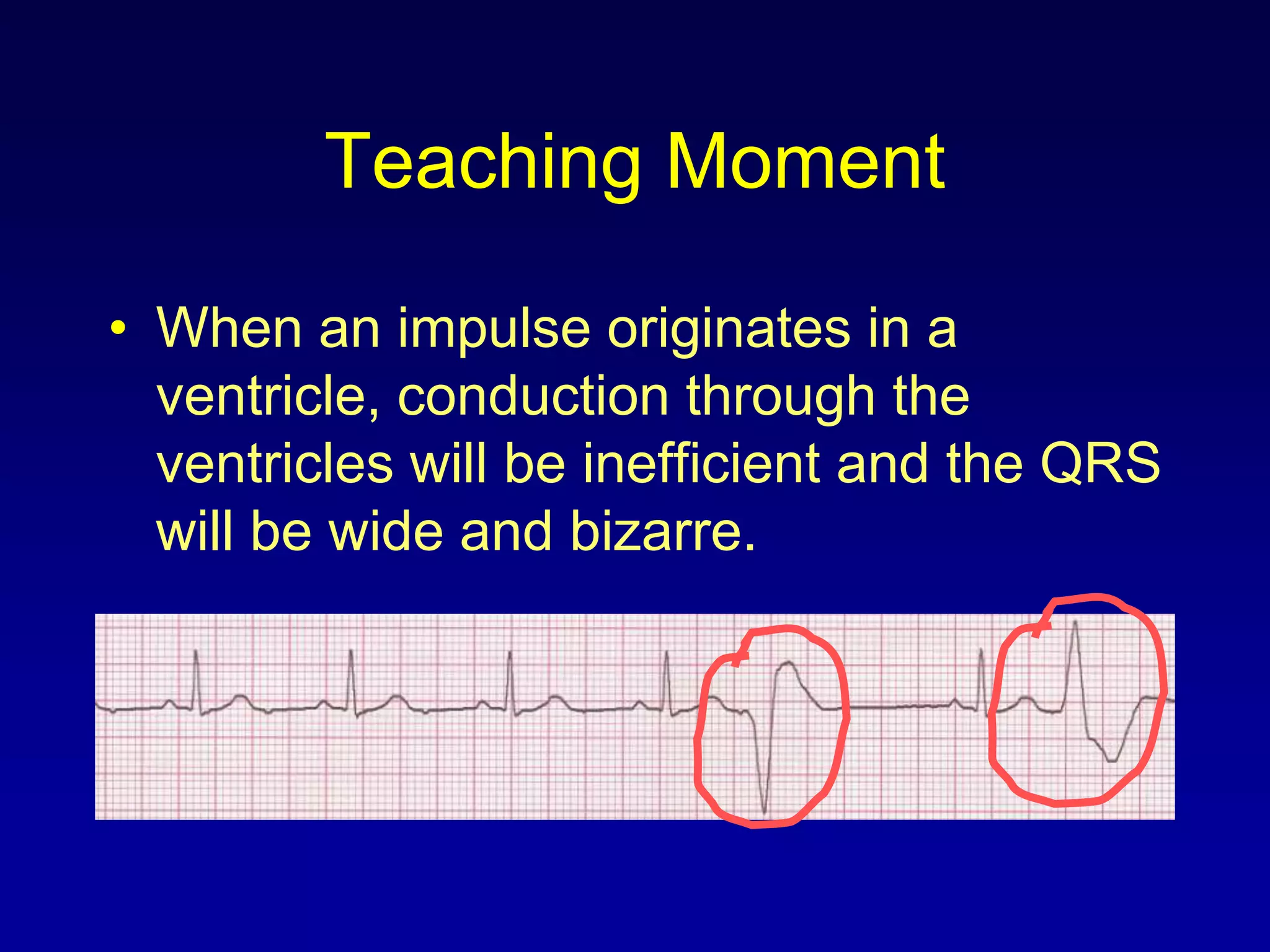 Ekg module 4a | PPTX
