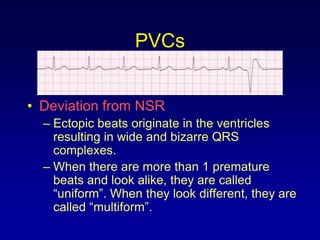 Ekg module 4a | PPTX