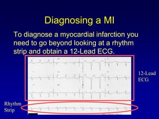 Myocardial Infarction Ecg Strip
