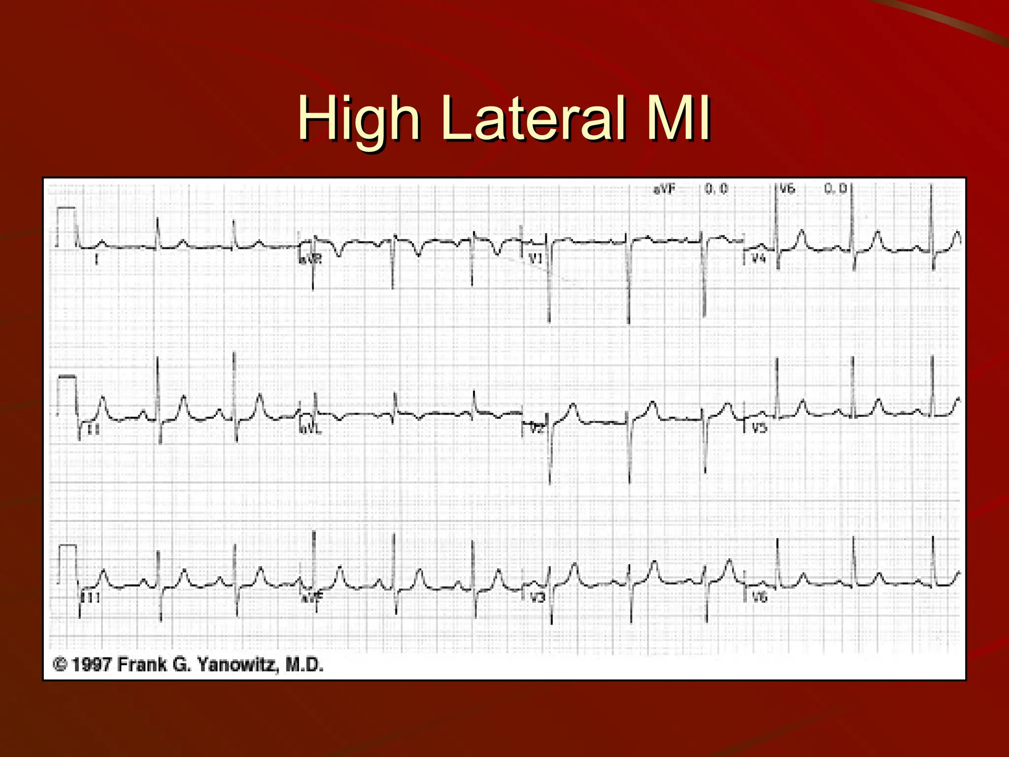 ekg_myocardial_infarction_ischemic_states.ppt