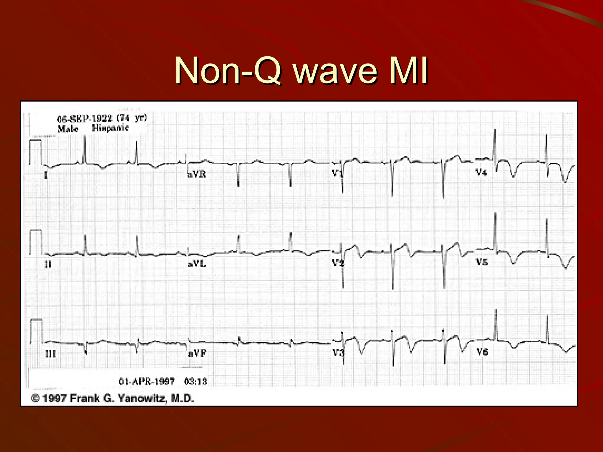 ekg_myocardial_infarction_ischemic_states.ppt