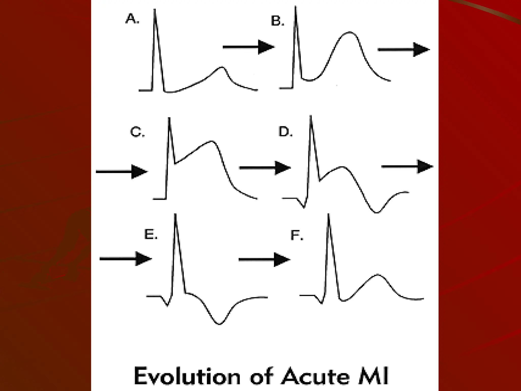 ekg_myocardial_infarction_ischemic_states.ppt