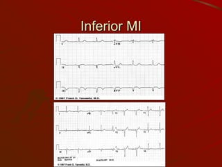 ekg_myocardial_infarction_ischemic_states.ppt
