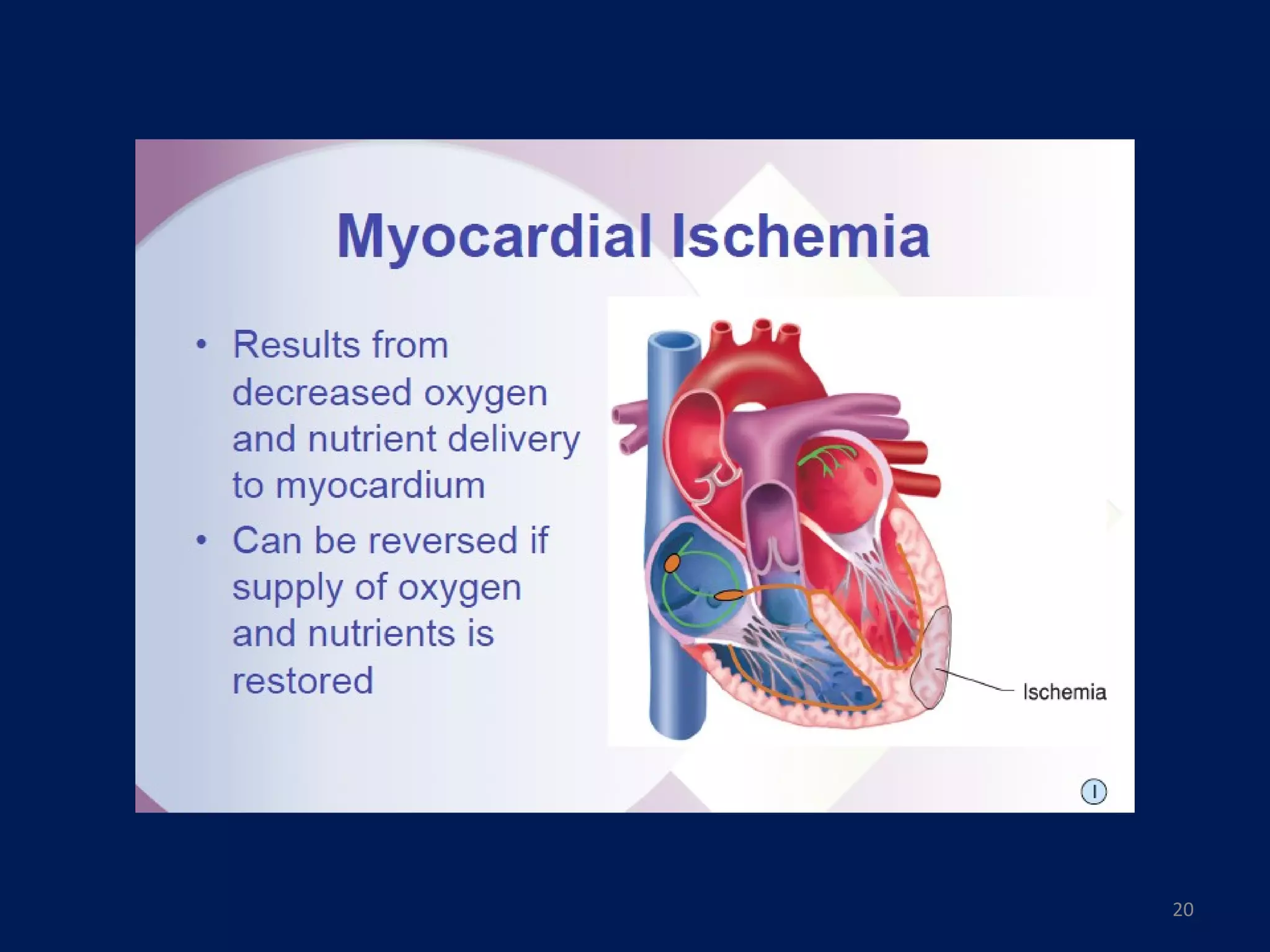 Ekg myocardial ischemia & Infarction | PPT
