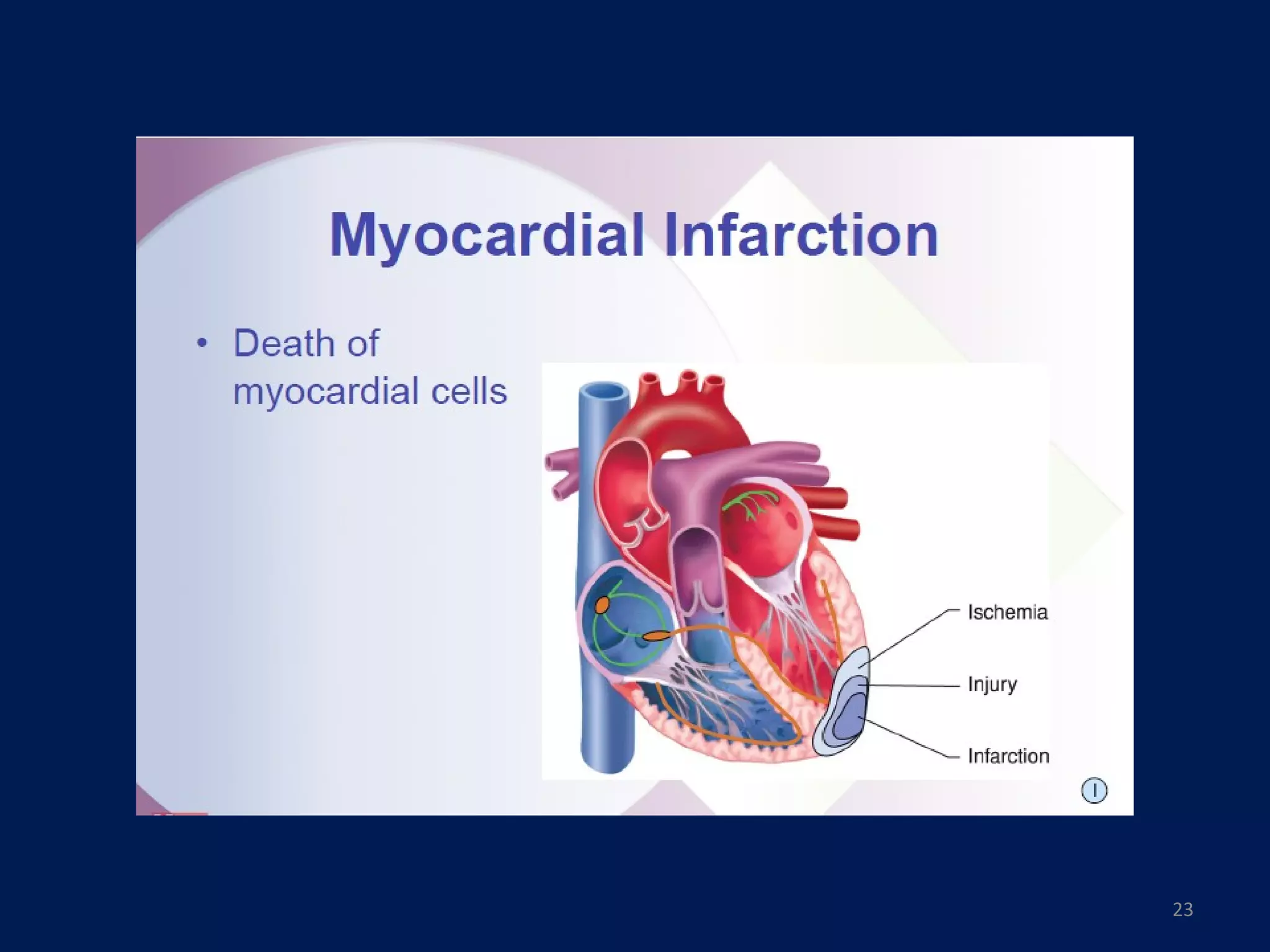 Ekg myocardial ischemia & Infarction | PPT