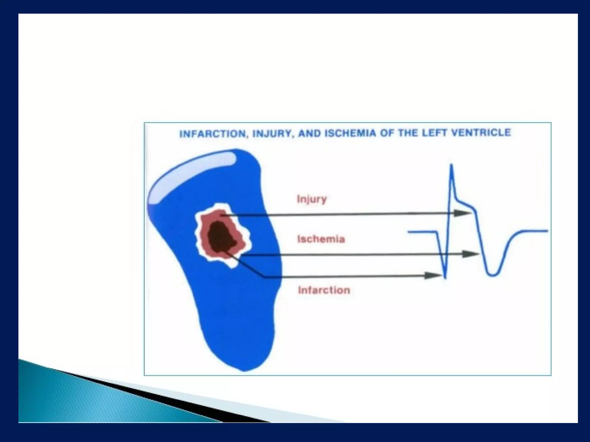 Ekg myocardial ischemia & Infarction | PPT
