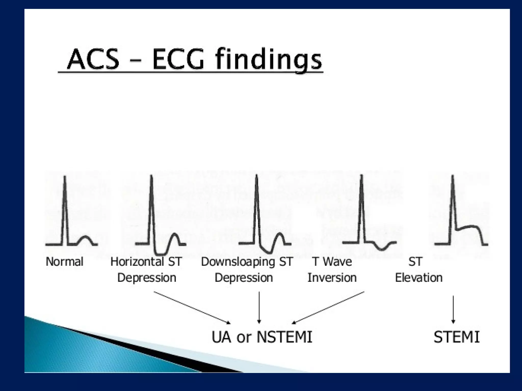 Ekg myocardial ischemia & Infarction | PPT