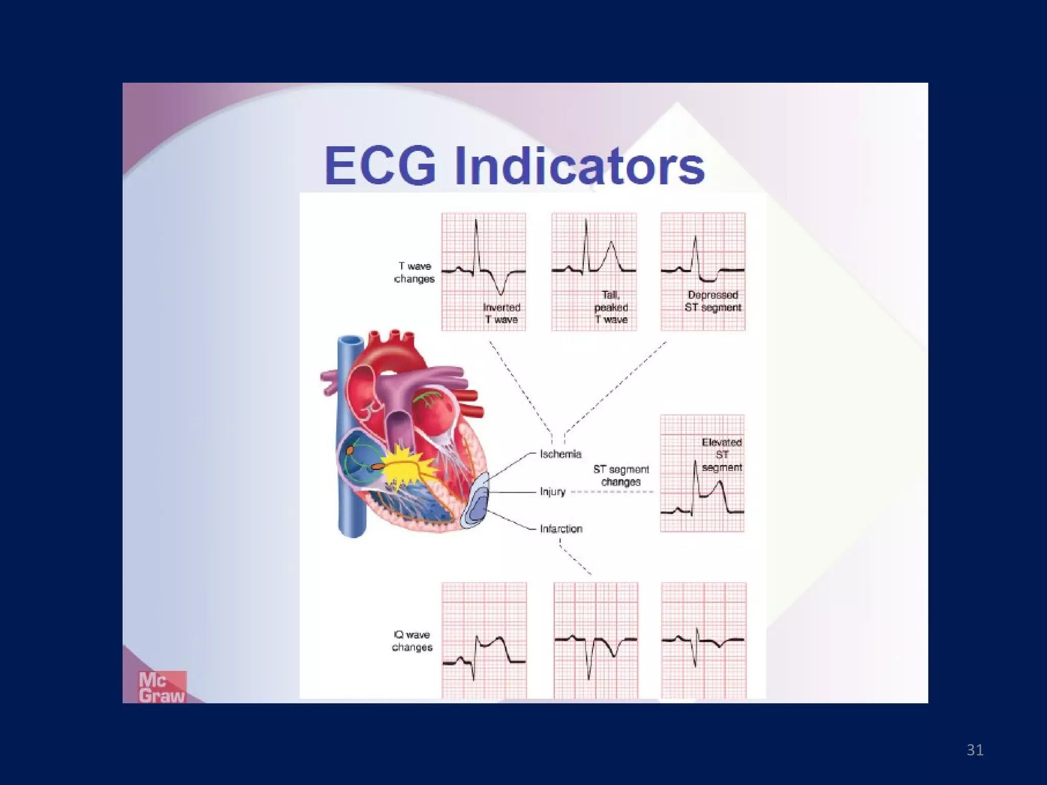 Ekg myocardial ischemia & Infarction | PPT