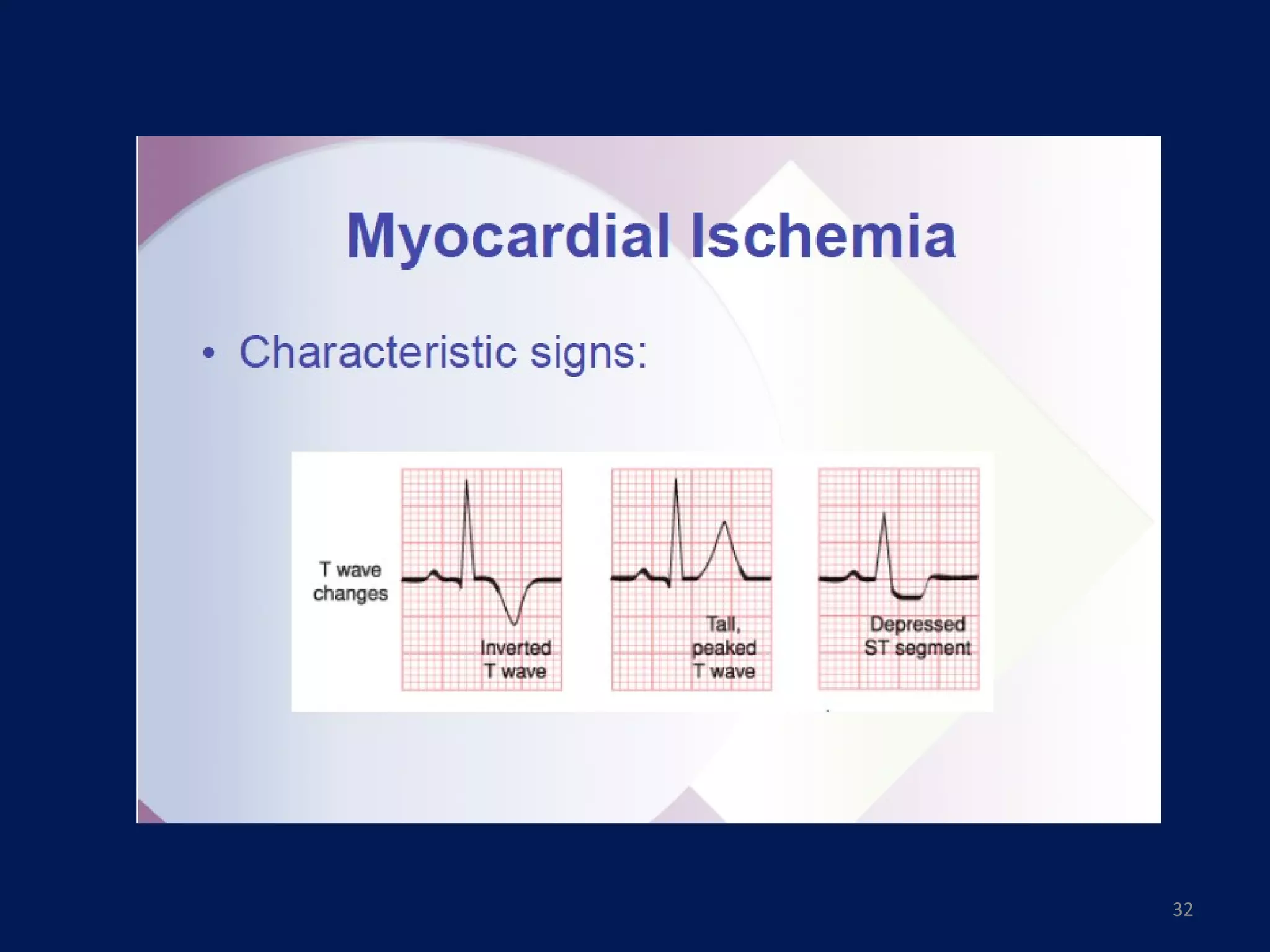 Ekg myocardial ischemia & Infarction | PPT