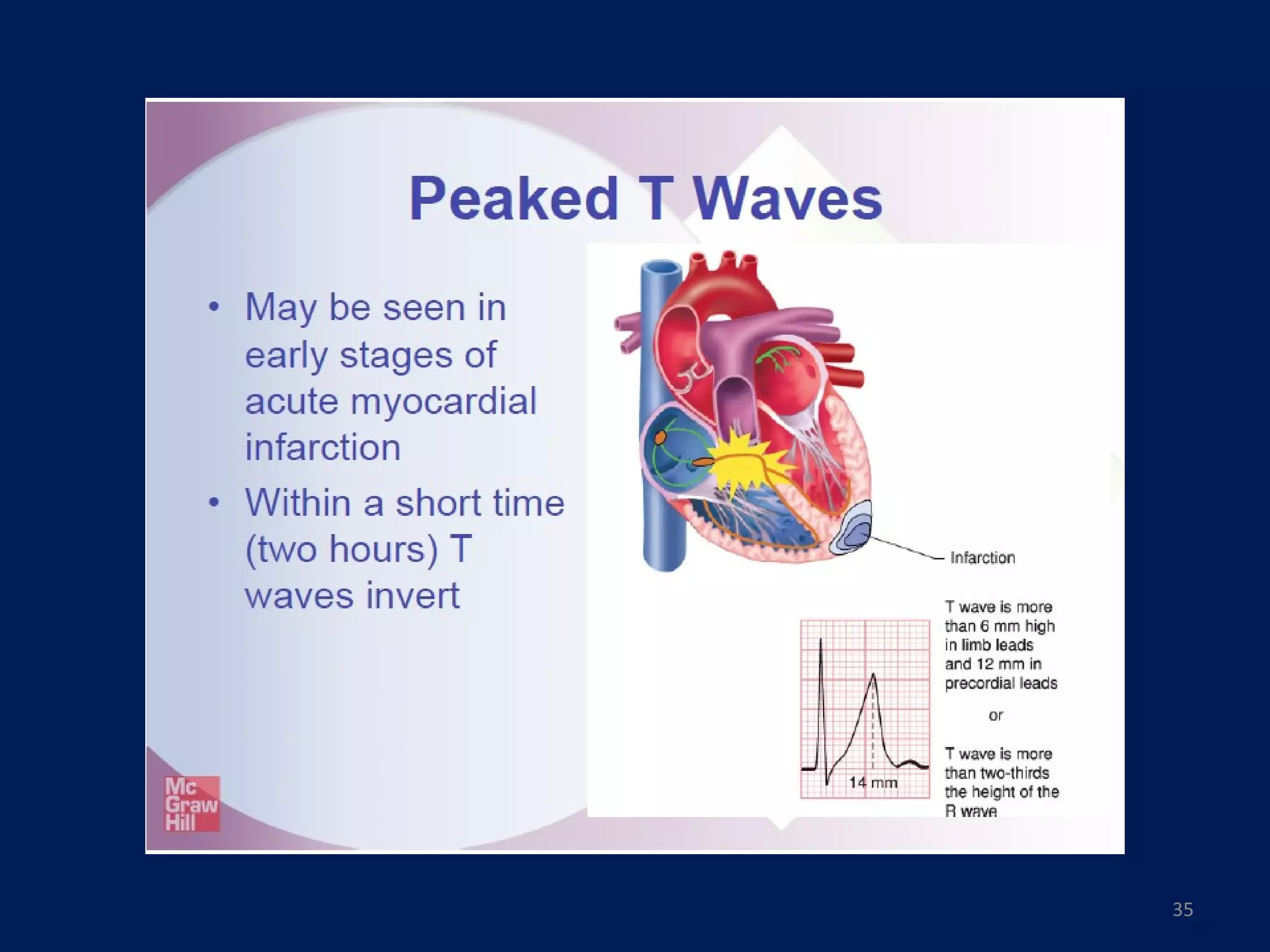 Ekg myocardial ischemia & Infarction | PPT