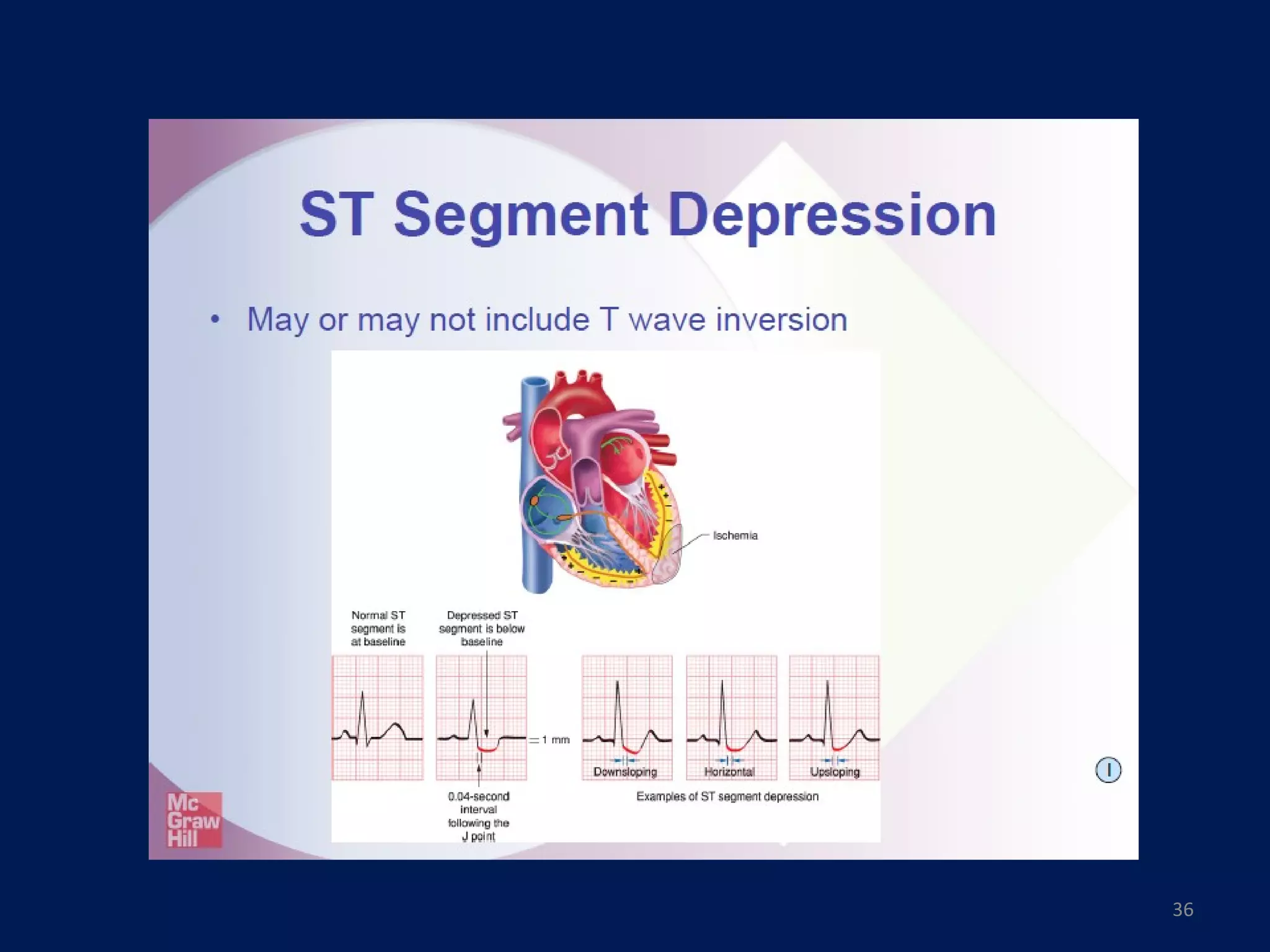 Ekg myocardial ischemia & Infarction | PPT
