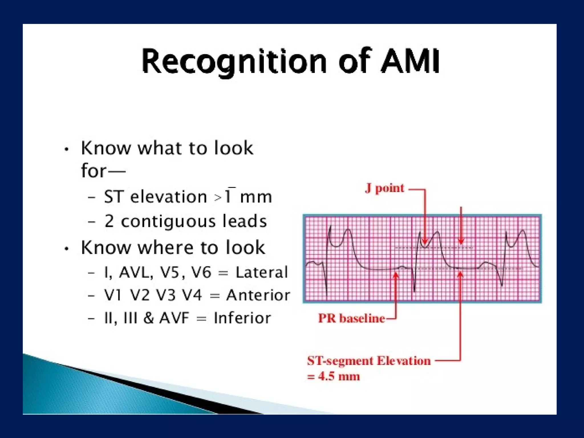 Ekg myocardial ischemia & Infarction | PPT